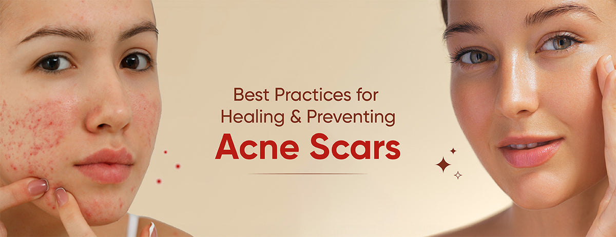 Best Practices for Healing and Preventing Acne Scars – ozoneayurvedics