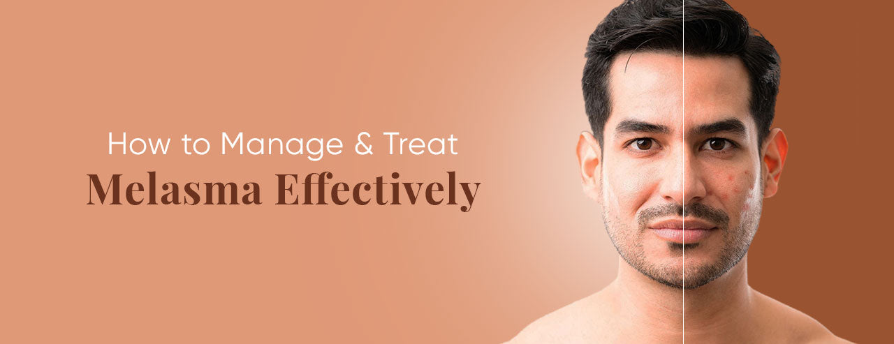 How to Manage and Treat Melasma Effectively – Ozone Ayurvedics